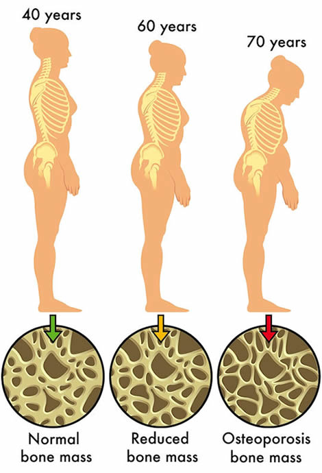 About Health: Osteoporosis