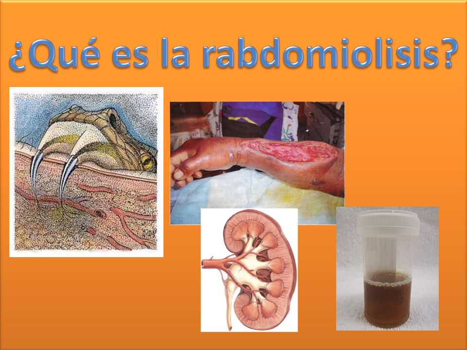 BREA VENENOS: ¿Qué es la rabdomiolisis?