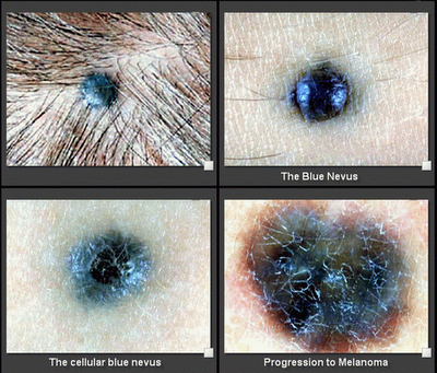 Doctors Gates: Photos and information about Blue Nevus