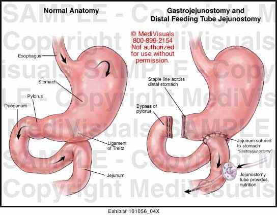 Shooting For Liam: Feeding Tubes: Whats the difference?