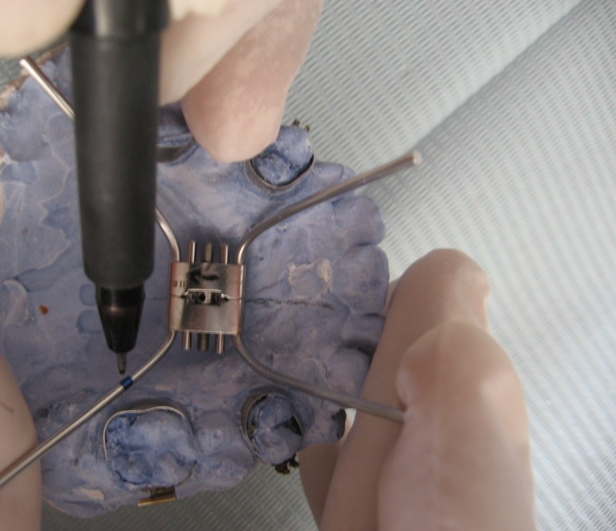 ODONTO-ESTOMATOLOGICA: APARATO DISYUNTOR HIRAX