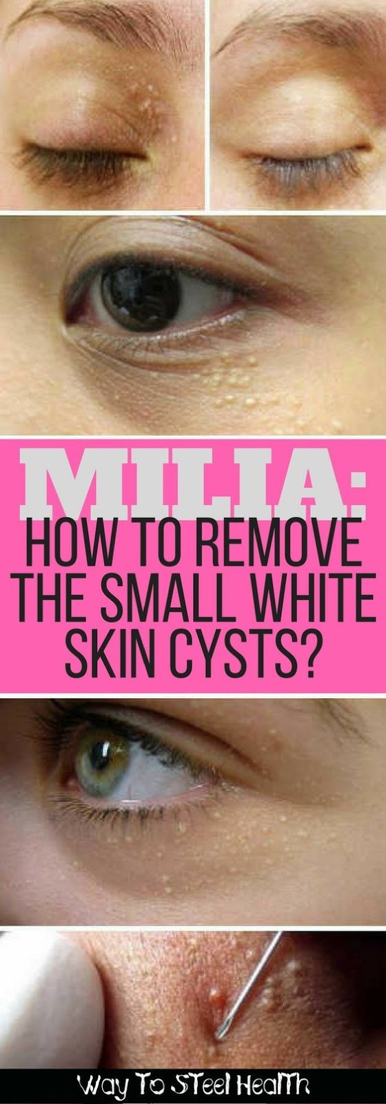 MILIA: How To Remove The Small White Skin Cysts? - Fitness Fiesta