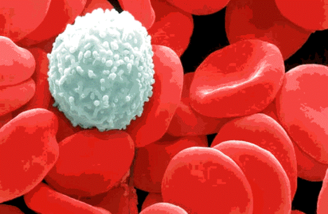 Patologias: 1- La leucemia