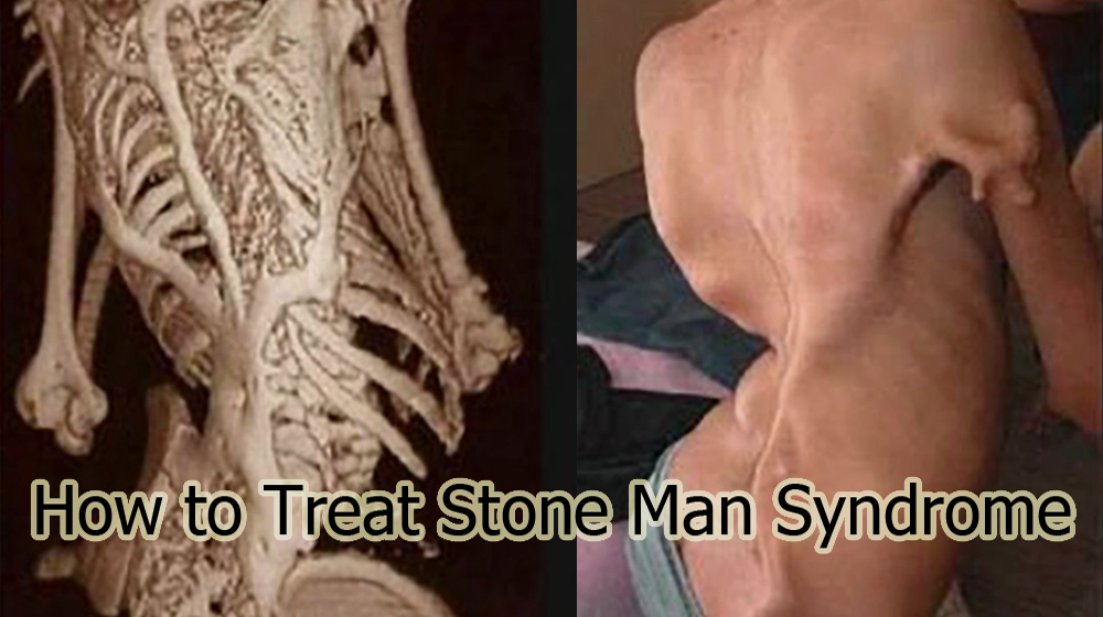 How to Treat Stone Man Syndrome