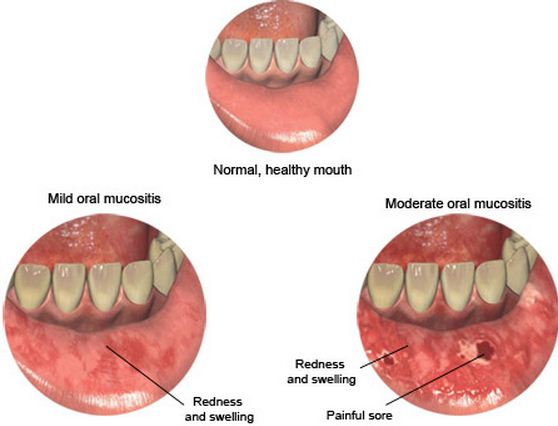 injury of the mucosal lining |Genetic Engineering Info