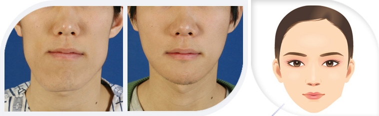 BK Plastic Surgery: [BK Plastic Surgery] Facial bone contouring: Facial ...