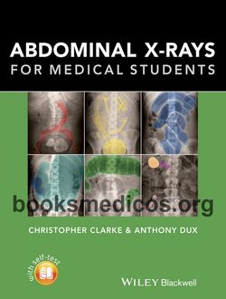 Abdominal X-rays for Medical Students | booksmedicos