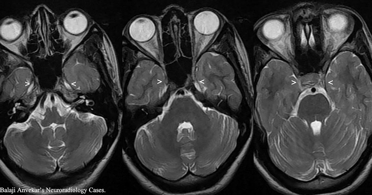 Dr Balaji Anvekar FRCR: Bilateral ICA hypoplasia