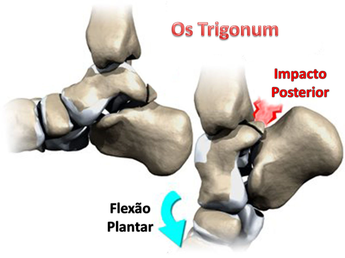 Clínica e Cirurgia do Pé e Tornozelo: Fraturas do Tálus