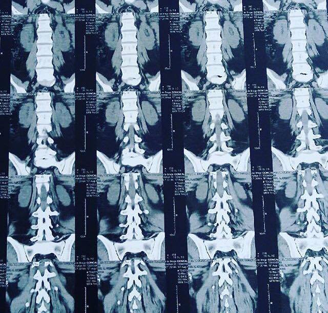 Coluna Torta? Sim, eu tenho... - Vanessa Lopes