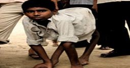 Polio-Risk Factors-Transmission-Symptoms-Treatment and Epidemic Countries