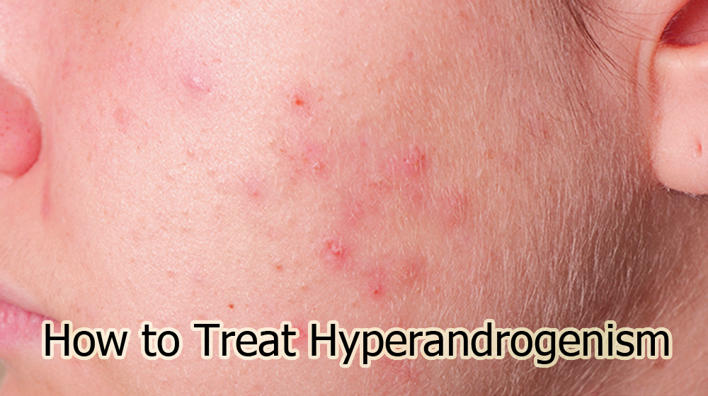 How to Treat Hyperandrogenism