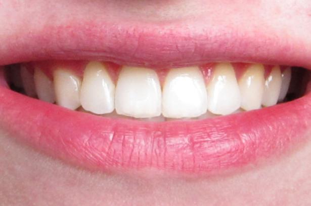 light teeth: Our picture galleries,teeth pictures and teeth fetish