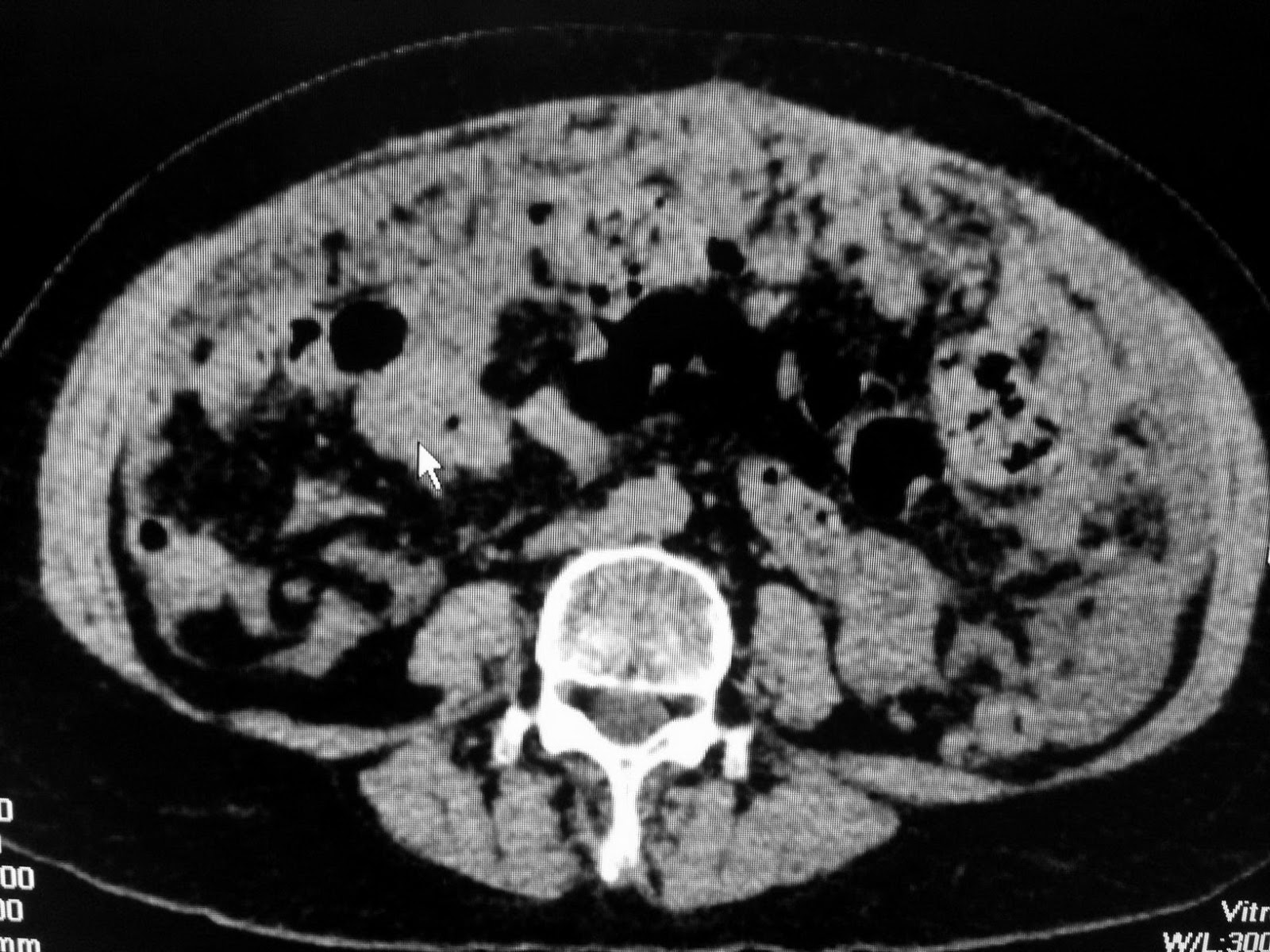 VIETNAMESE MEDIC ULTRASOUND: CASE 332 : PERITONEAL CARCINOMATOSIS, Dr ...