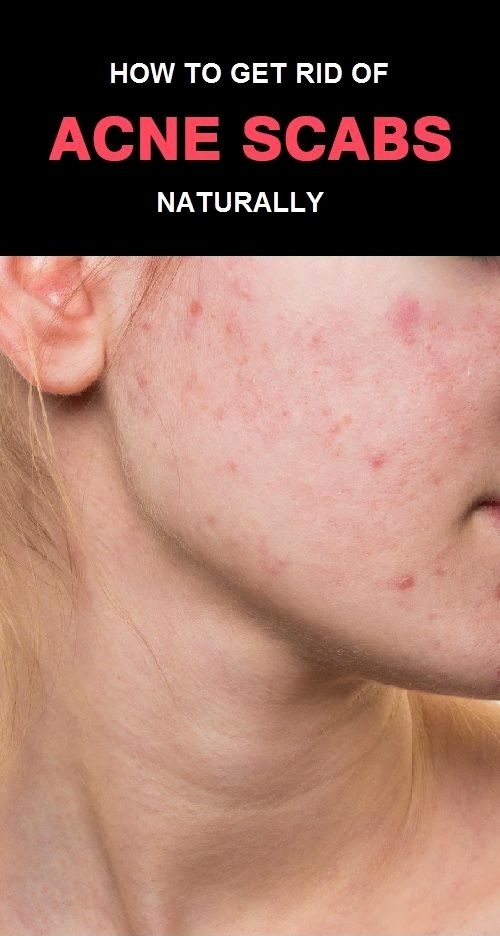 How to Get Rid of a Scab?