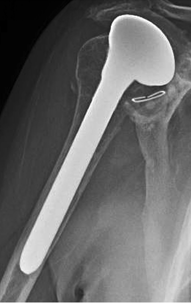 UW Shoulder and Elbow Academy: Bone-preserving humeral component ...