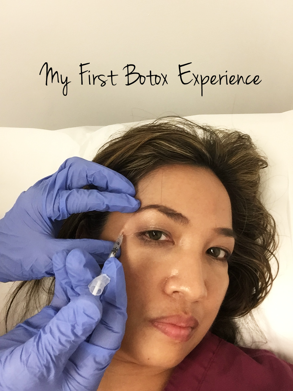 My First Botox Experience (Before & After Photos) - thefabzilla