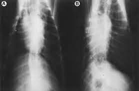 Medical Treatment Pictures-for Better Understanding: Pneumonectomy ...