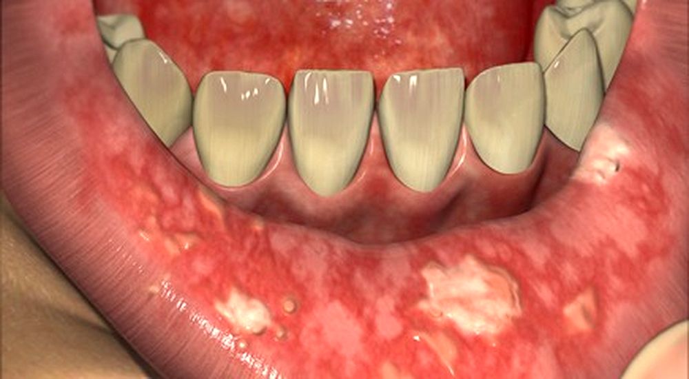 ORAL MEDICINE : What is Oral Mucositis? | Directorio Odontológico