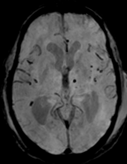 Amyloid Angiopathy: MRI - Sumer's Radiology Blog