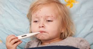 Ubat Chicken Pox Dewasa Sampai Dia Jadi Miss Universe Semula | Diet ...