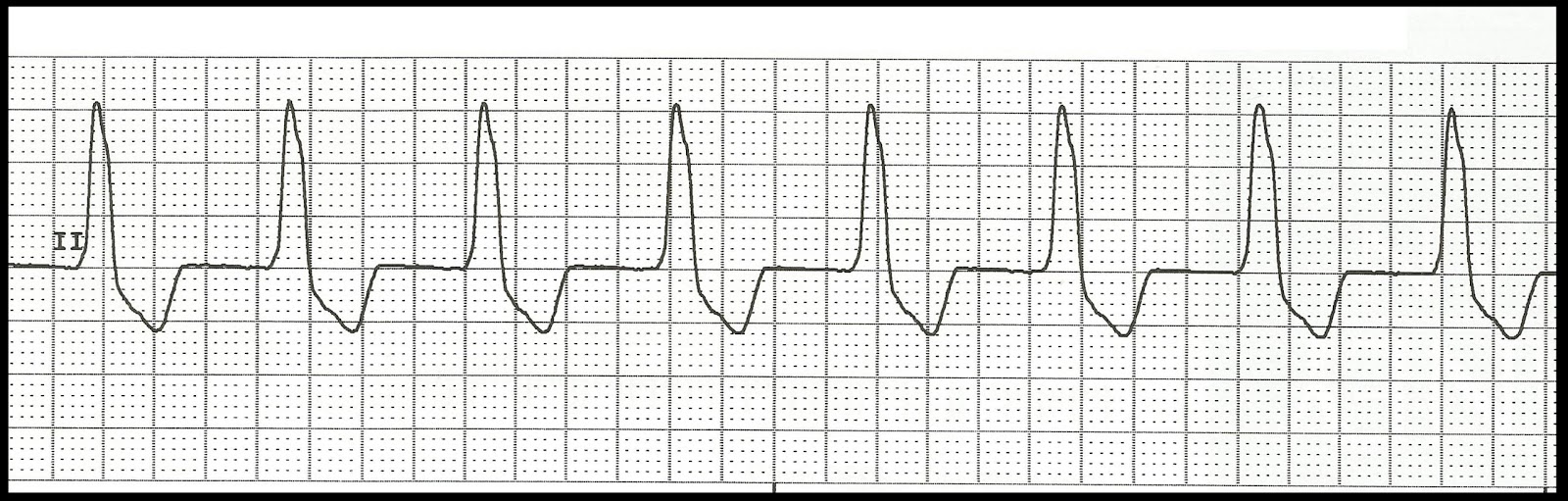 Basic ECG Rhythm Test 03