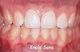 Enfermedad periodontal: ENCIA