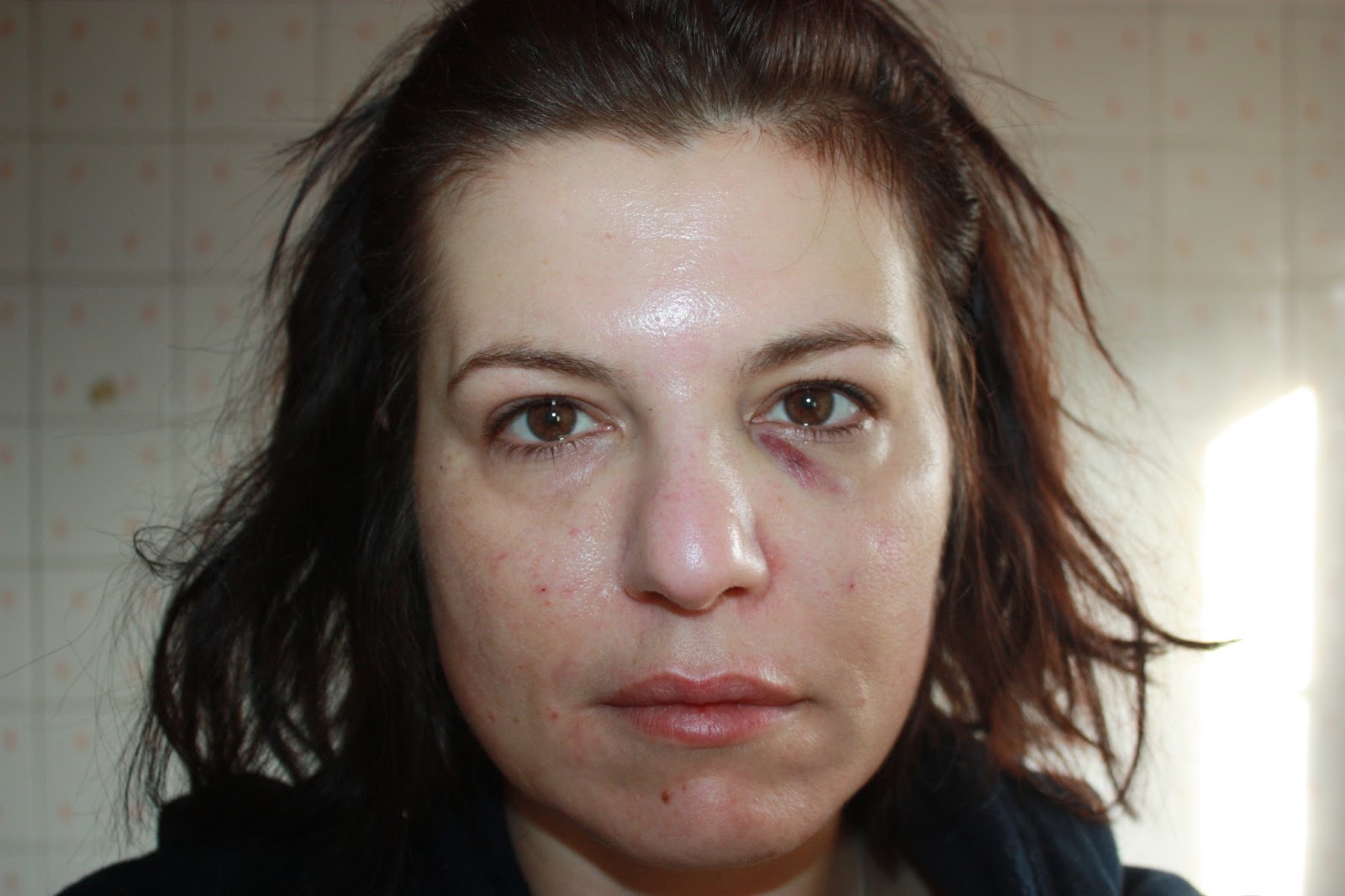 Dear Skin: LIPOGEMS TRETMAN AUTOLOGNIH MATIČNIH STANICA IZ MASNOG TKIVA