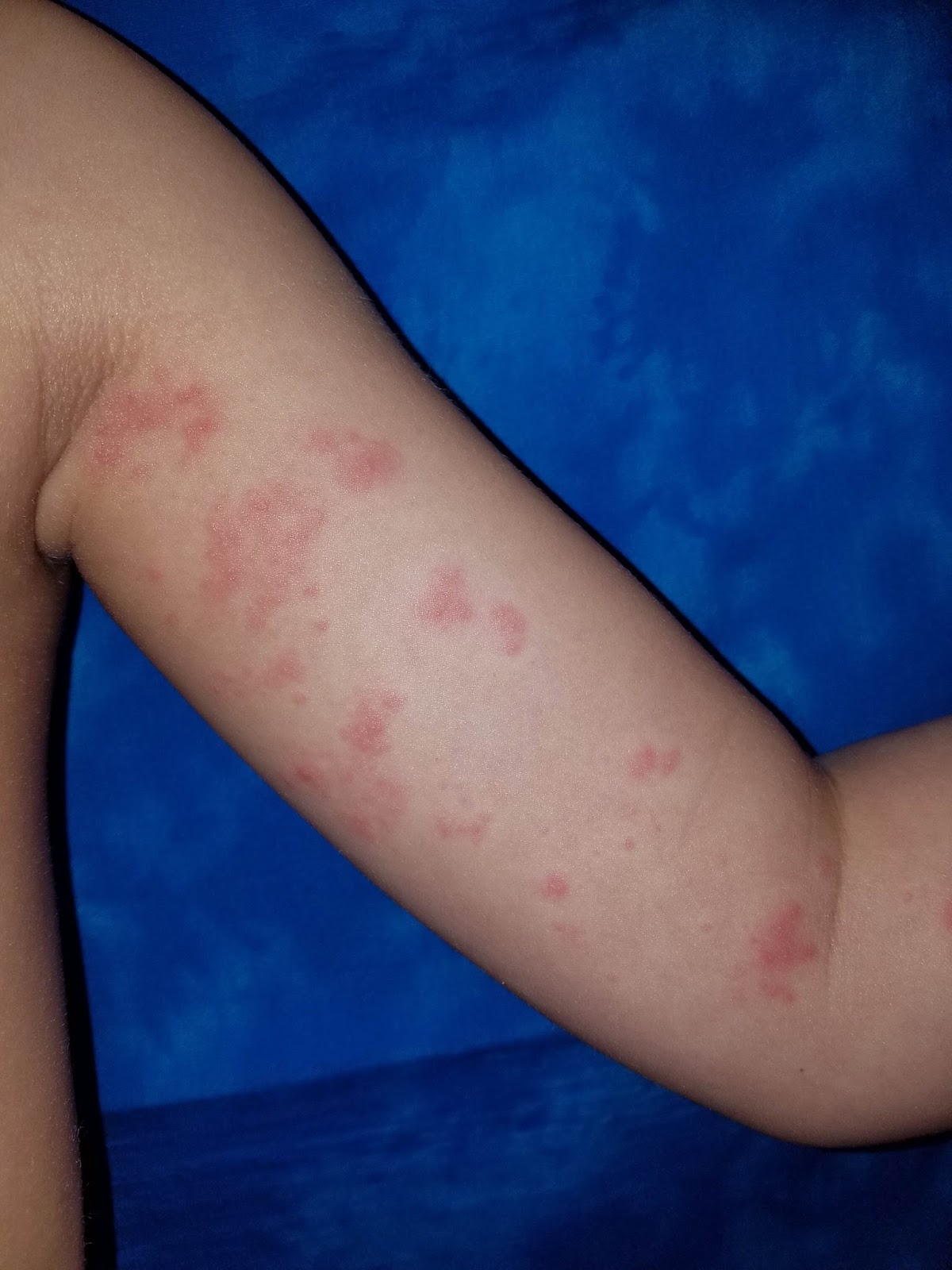 VIRTUAL GRAND ROUNDS IN DERMATOLOGY 2.0: Herpes Zoster in a 10 year-old