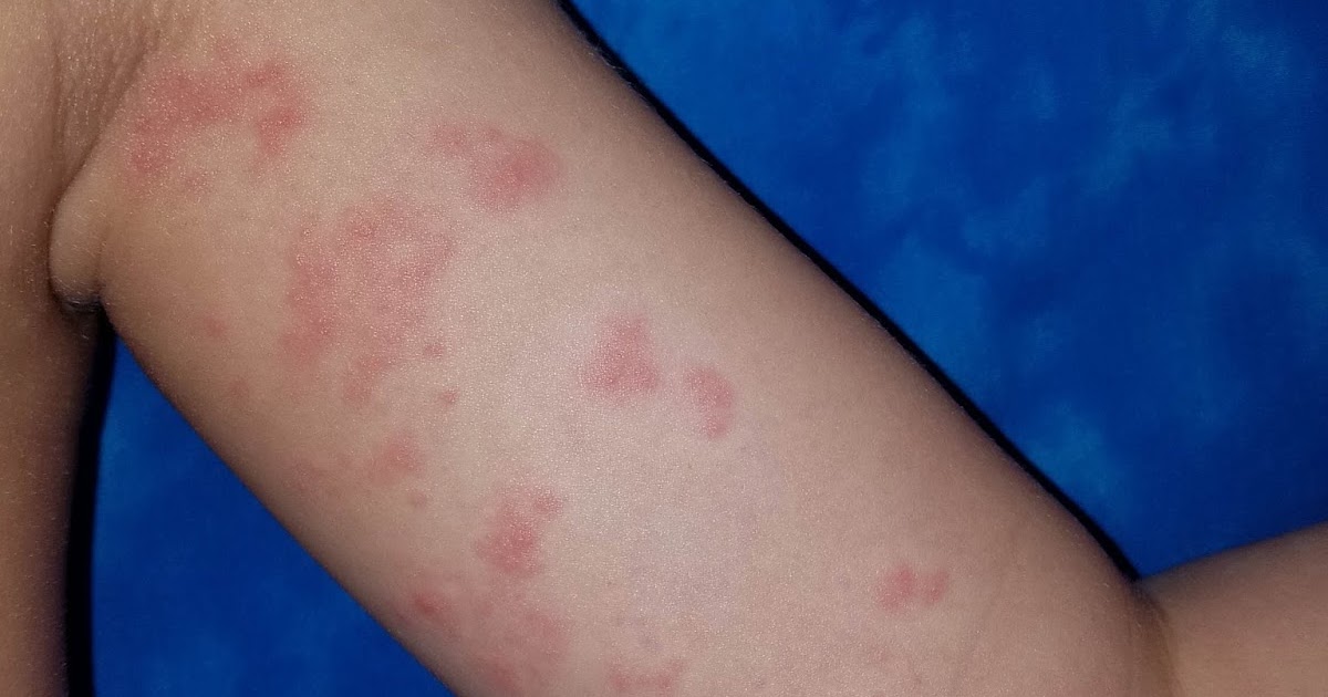 VIRTUAL GRAND ROUNDS IN DERMATOLOGY 2.0: Herpes Zoster in a 10 year-old