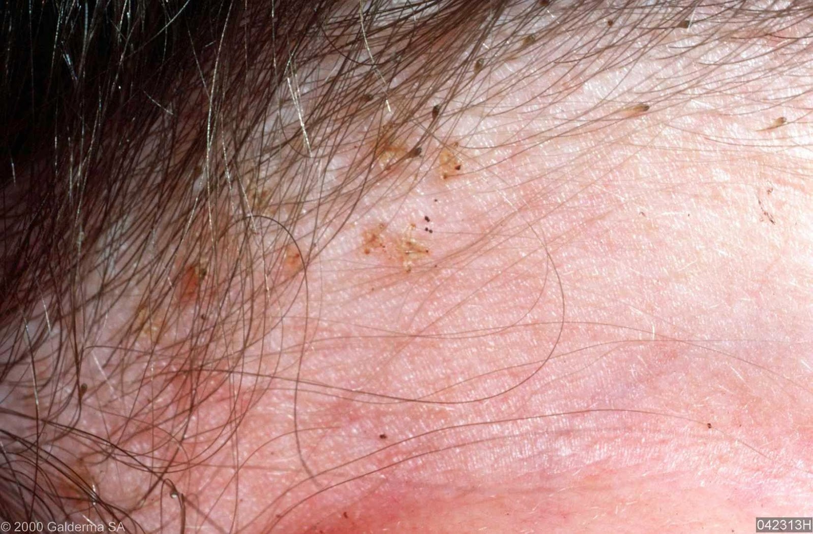 SKIN DISEASE TYPES: Pediculosis