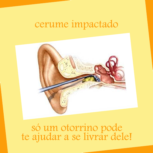 Cerumen (cera) impactado: o que é? Quem pode me ajudar? ~ Profª Drª Tanit Ganz Sanchez