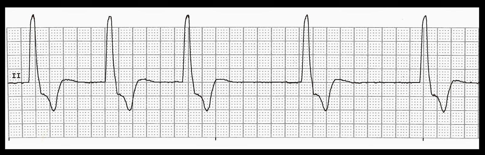 Various Idioventricular Rhythms
