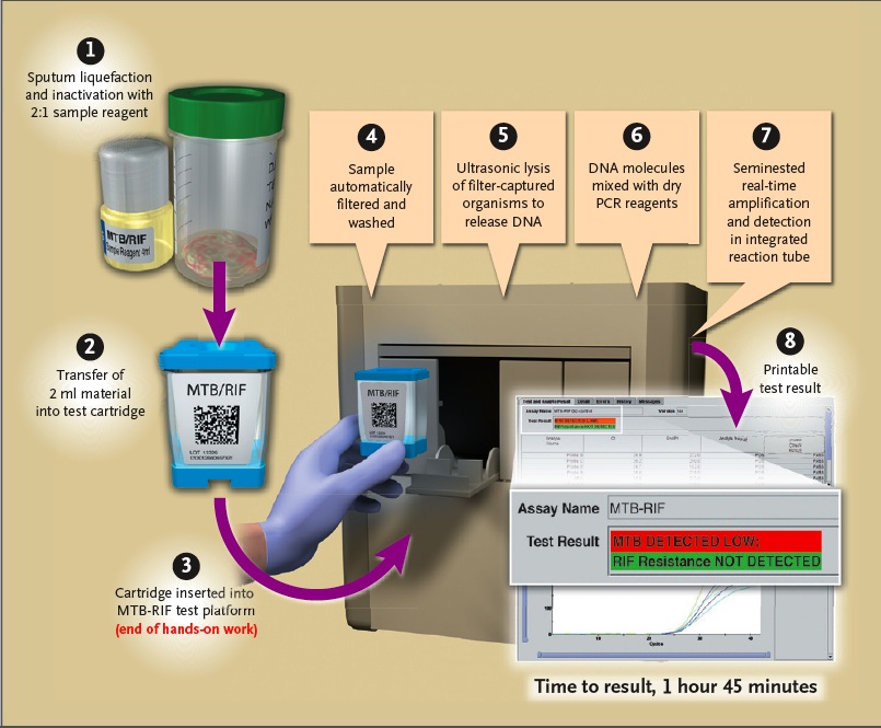 INFECTOLOGIA: Xpert MTB/RIF