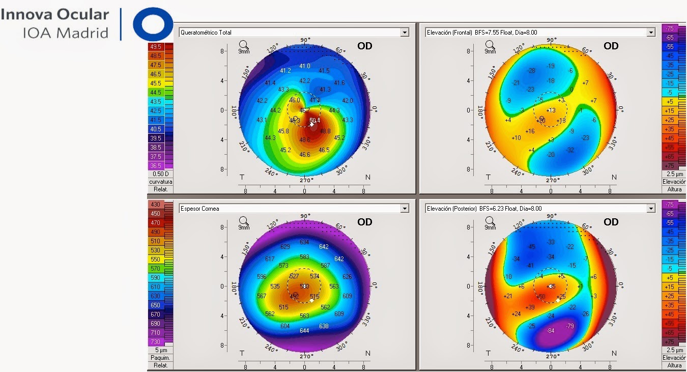 Miranza IOA: EL QUERATOCONO; CAUSAS Y TRATAMIENTO