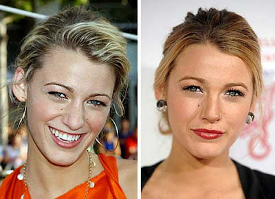 Celebrity Nose Jobs: Black Lively Nose Job Plastic Surgery Before and ...