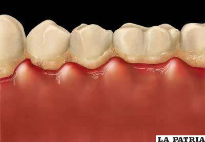 ¿QUÉ ES SARRO O TÁRTARO DENTAL? | Odontologia Preventiva