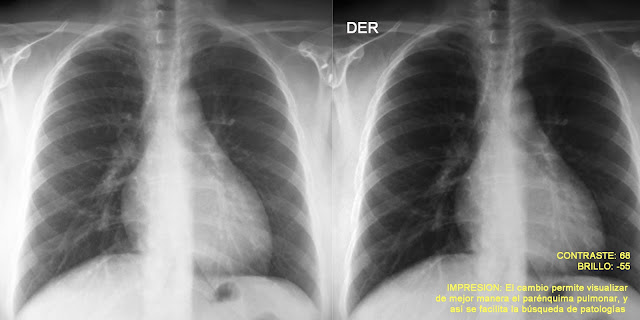RadioLuz: Radiografía torax normal