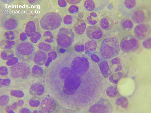 Hematología Fichas: Megacariocito