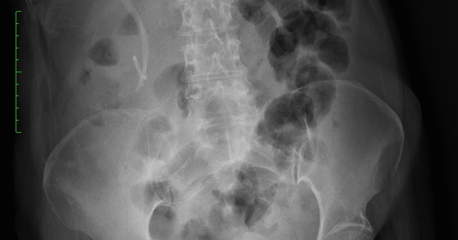 MEDICAL CONCEPTS: DJ AND CBD STENTS IN ABDOMINAL XRAY