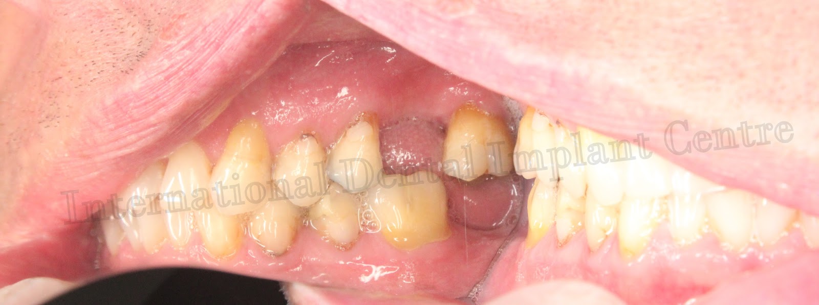 Dental implant cost guide india: Replacement of molar teeth with basal ...