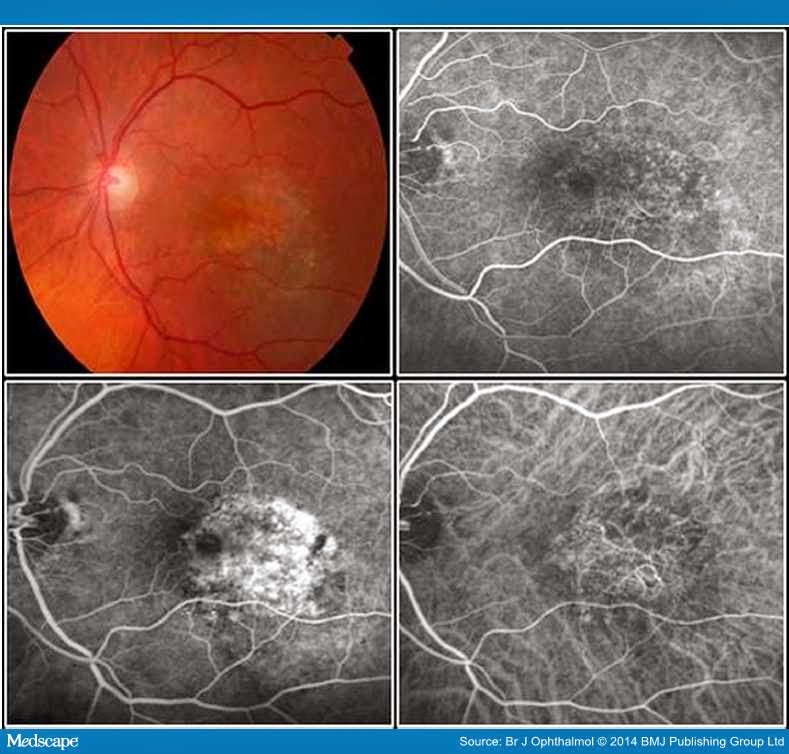 DEGENERACION MACULAR : DMAE humeda y la OCT
