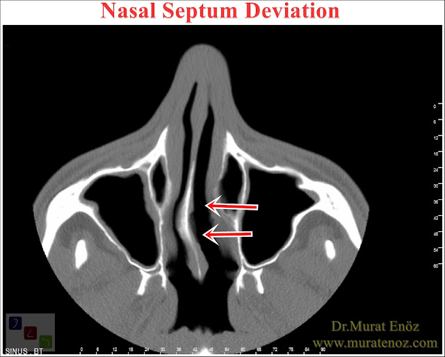 How Can You Understand That "Nasal Septum Deviation" Is In Your Nose?