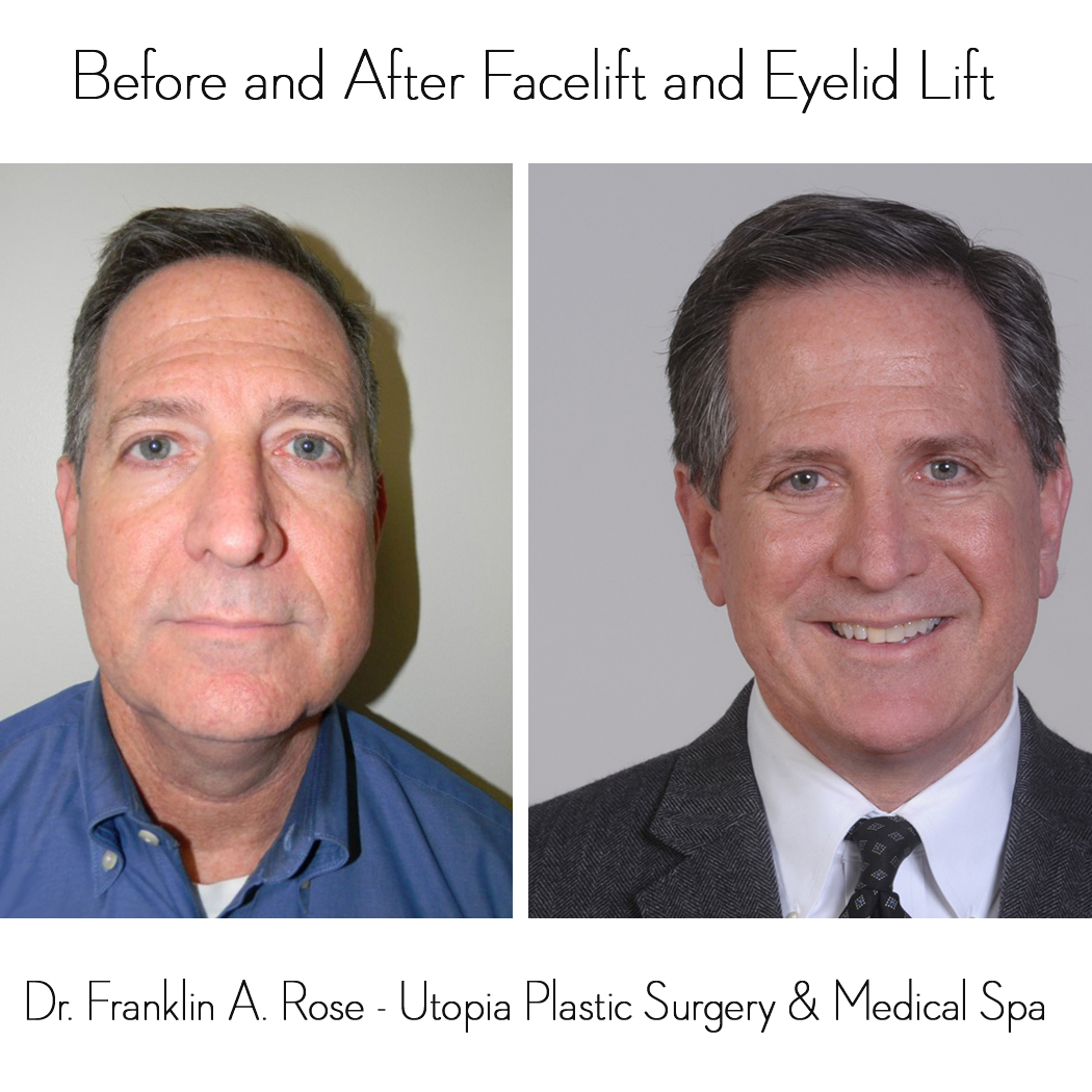 Dr. Franklin Rose Reviews & Houston Plastic Surgery Blog: Bill Clinton ...