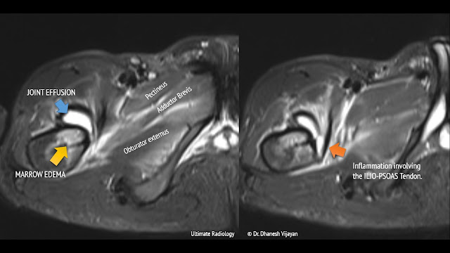 Ultimate Radiology : Septic arthritis of hip joint