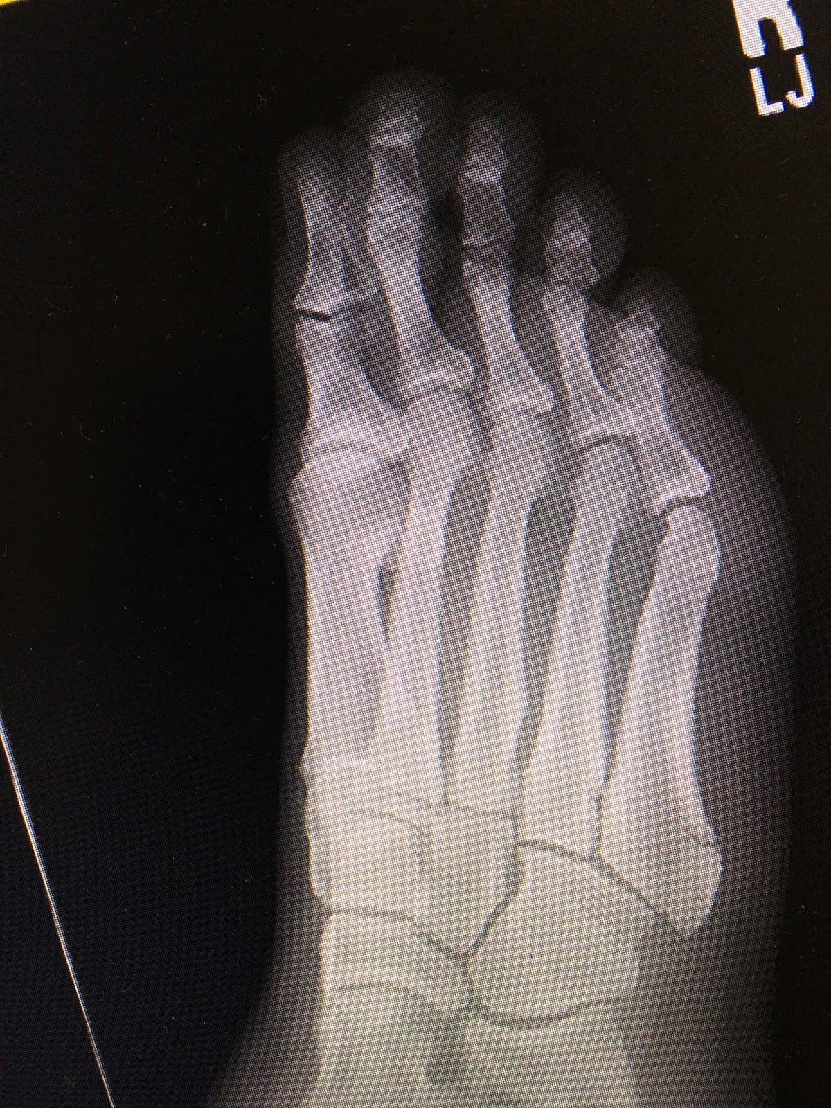 Dr. Drew Chapman Foot and Ankle Facts: Jones Fractures