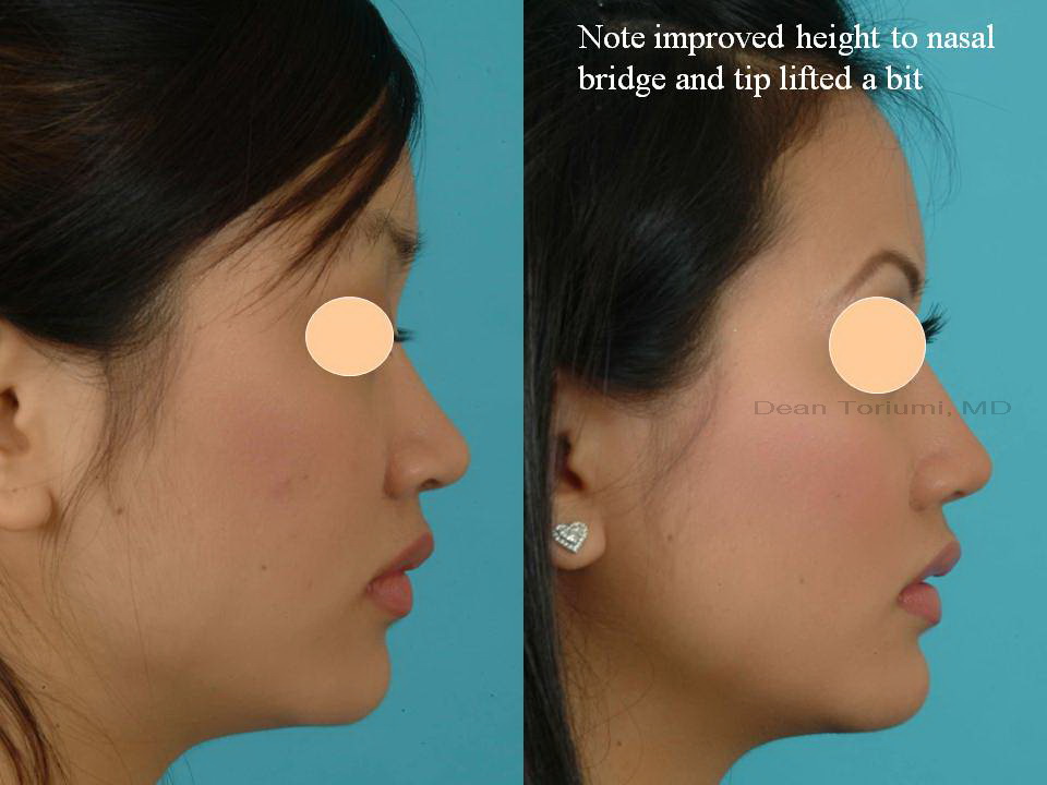 Dr. Dean Toriumi Reviews: Dean Toriumi Reviews: Augmentation with ...