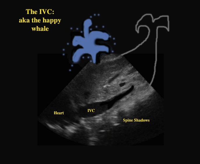 IVC: Happy Whale ~ Ultrasound Cases Info