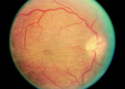 GLAUCOMA SPECIALIST BLOG: "THE GLOG": June 2017