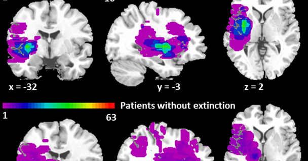 感じるのに感じない 脳卒中の感覚消失とは | 脳卒中サバイバのゼンデラ Ⅱ